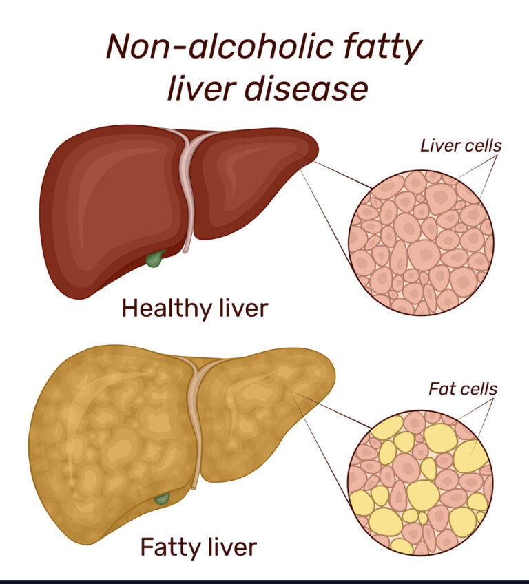 Non Alcoholic Fatty Liver Disease - Symptoms and Diagnosis - Prestege Wellness